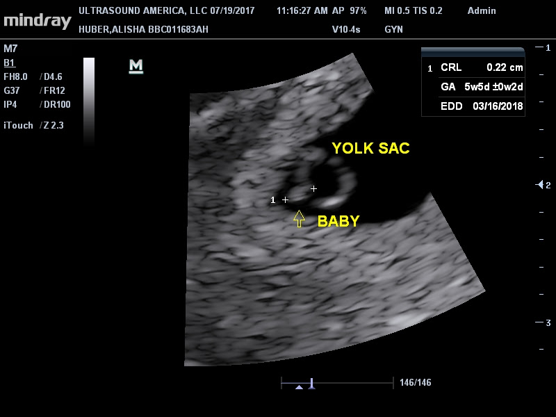Ultrasound–5 weeks, 5 days – Cinnamon and Sassafras